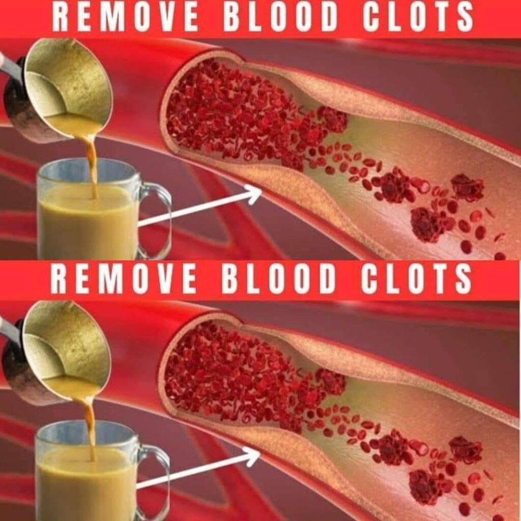 1 Cup a Day and You Will Never Get a Blood Clot: Turmeric and Ginger ...
