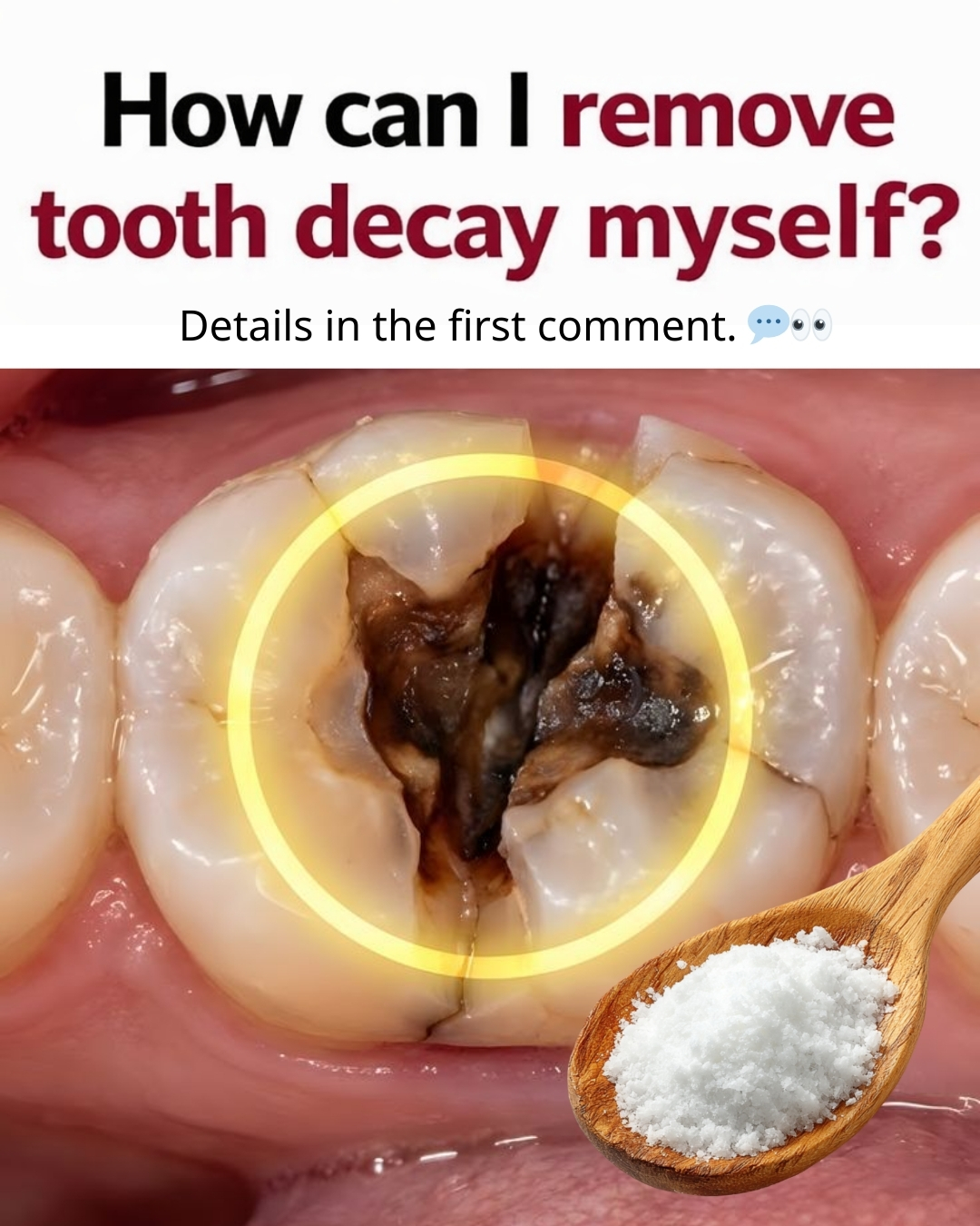 How Can I Remove Tooth Decay Myself? The Honest Truth (And What ...