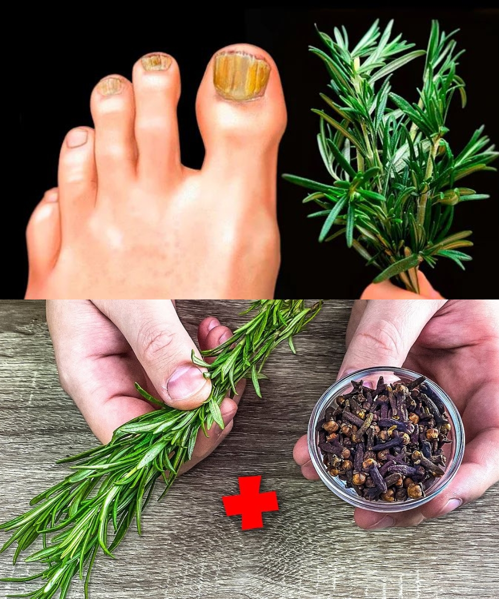 Rosemary and Clove Can Wipe Out Toenail Fungus Fast! – TREND HUB NEWS